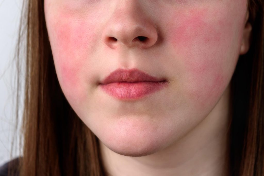 Fifth Disease in Kids - Pediatric Associates of Austin